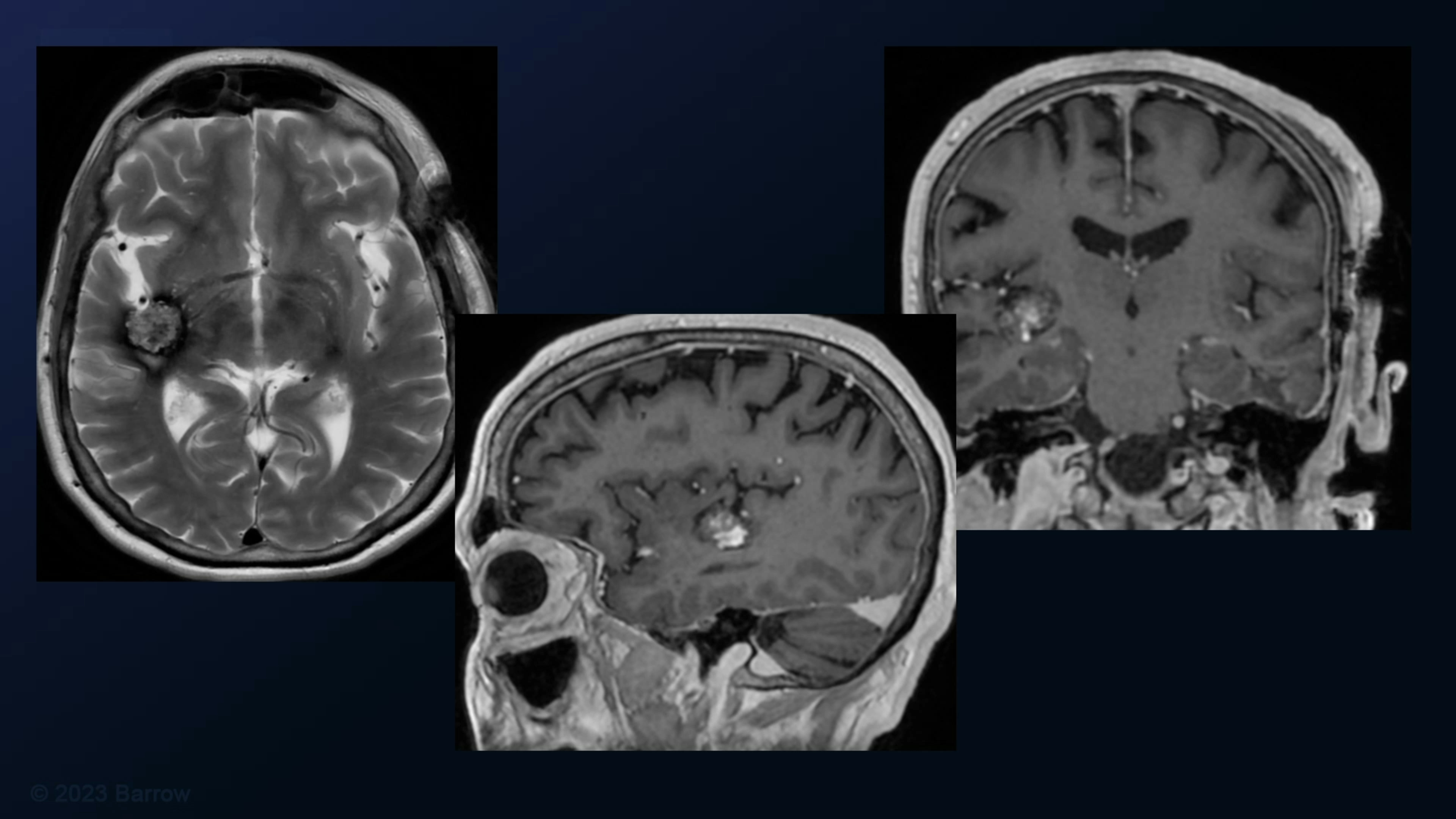 Seven Series - Barrow Neurological Institute