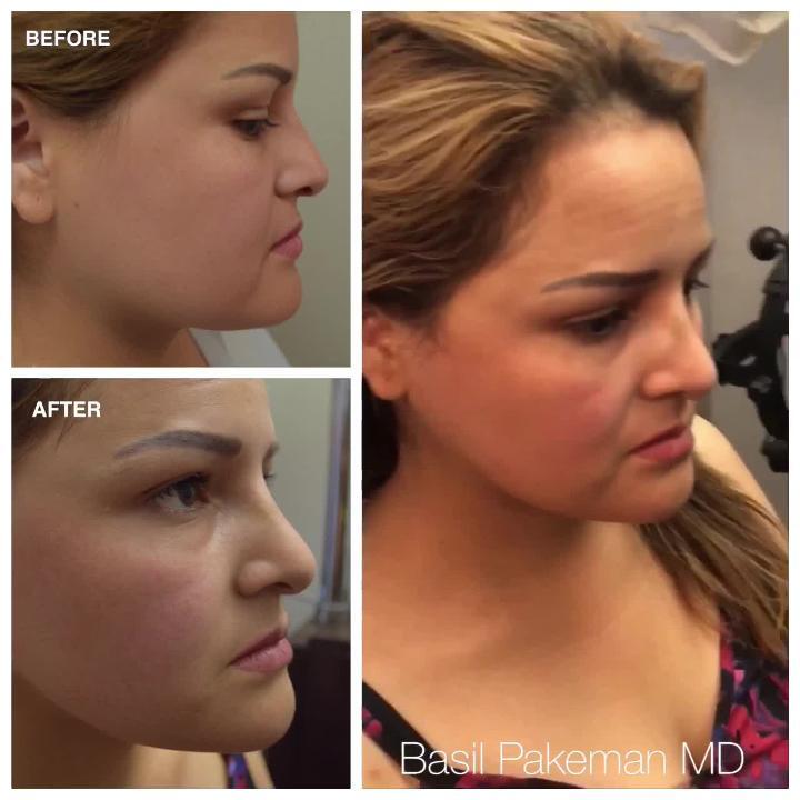 Buccal Fat Pad Removal - Video - RealSelf