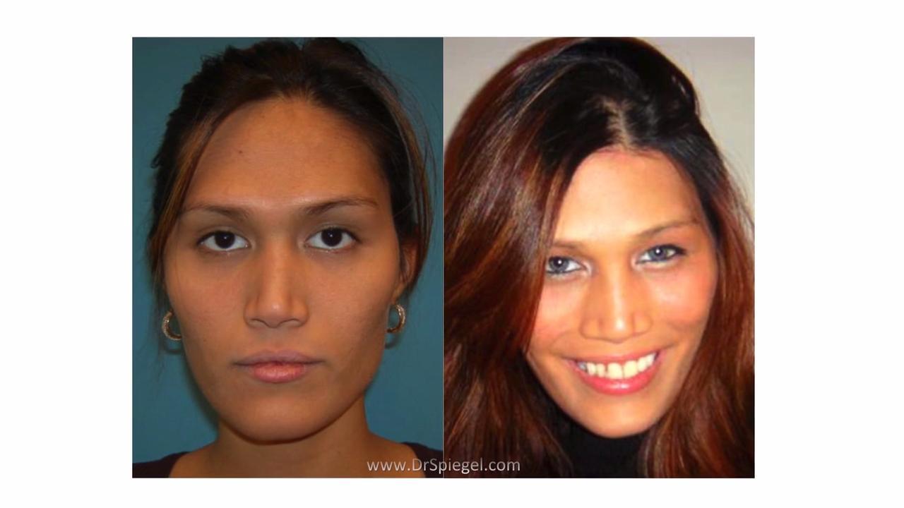 Asian Plastic Surgery with Dr. Spiegel - Video - RealSelf