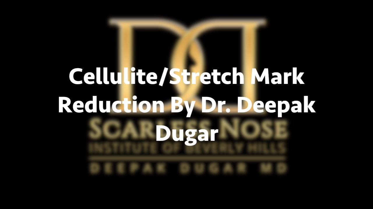 Cellulite/Stretch Mark Reduction Using Body FX Laser - Video - RealSelf