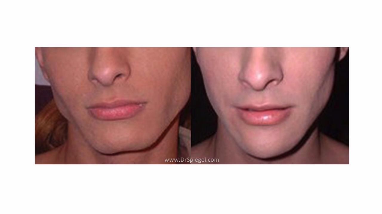 Mandible Contouring with Dr. Spiegel - Video - RealSelf
