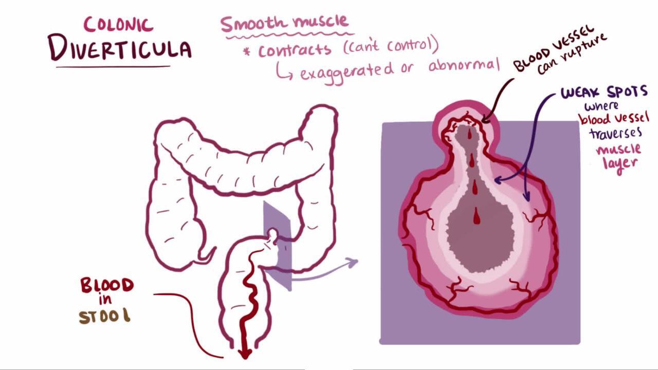 Colonic Diverticulitis - Gastrointestinal Disorders - Merck Manual ...