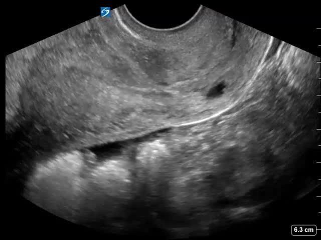 Quiste De Naboth Aandoeningen