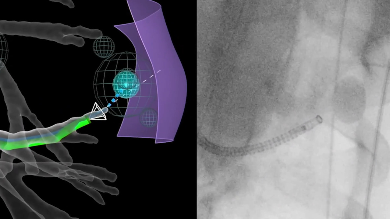 Ion Platform | Robotic-Assisted Bronchoscopy | Intuitive