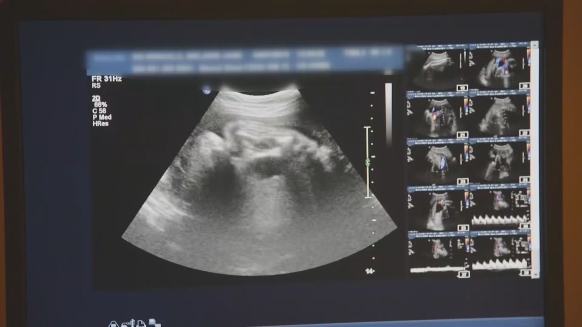 Researchers discover test to identify preterm birth risk