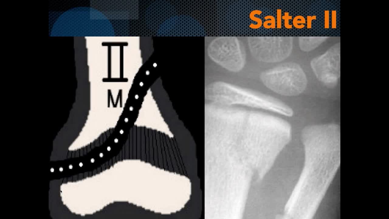 Salter Ii Fracture Radius