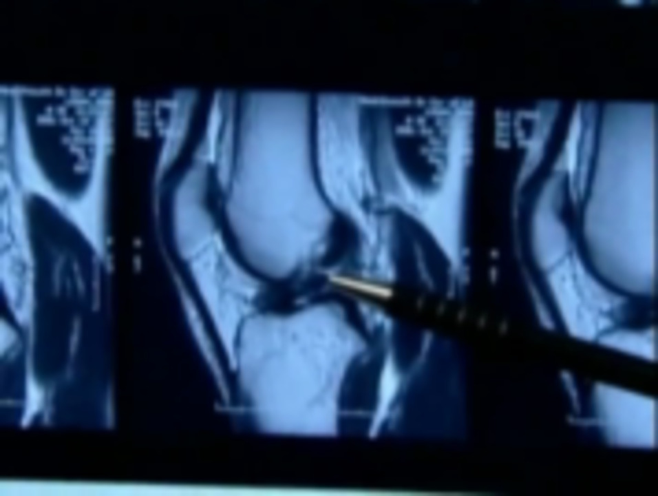 Derrick Rose Acl X Ray