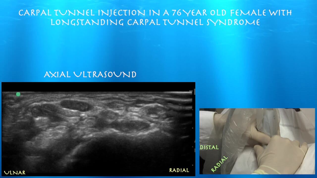 Carpal Tunnel Syndrome Injection