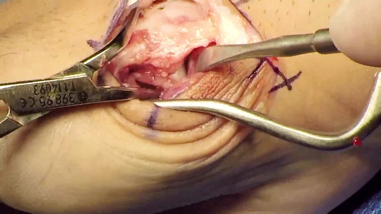 Bennett Fracture Operation