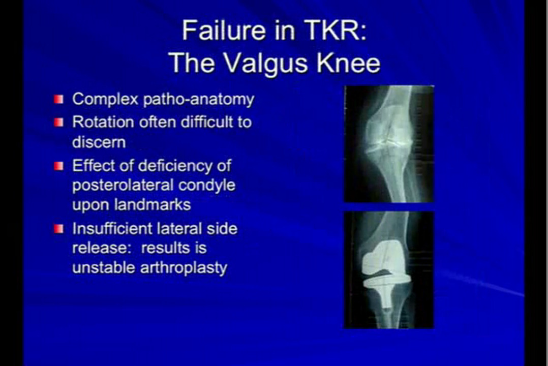 Knee Valgus Vs Varus