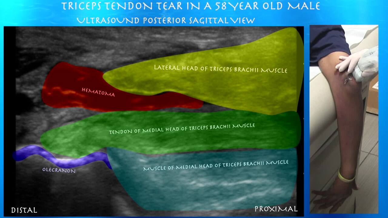 Triceps Tendon Tear