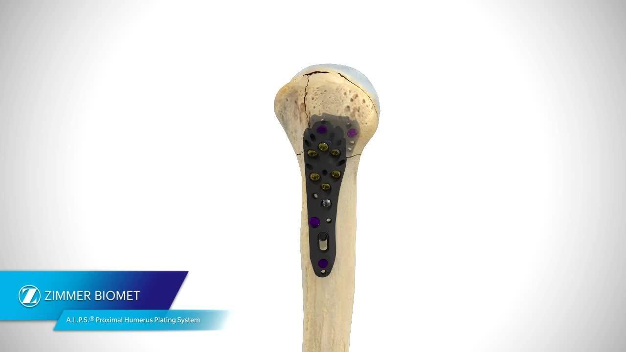 A.L.P.S. Proximal Humerus Plating System | Zimmer Biomet | Zimmer Biomet