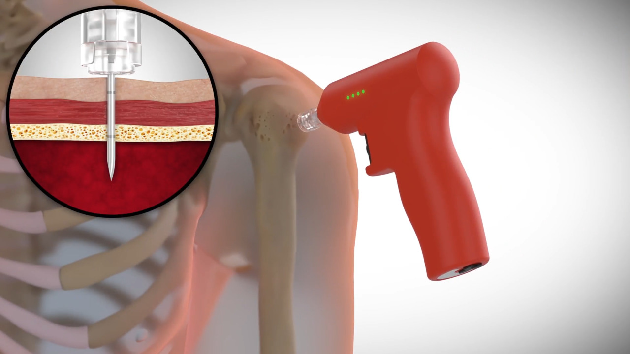 Resuscitation And The Humeral Intraosseous Line EMRA 59 OFF